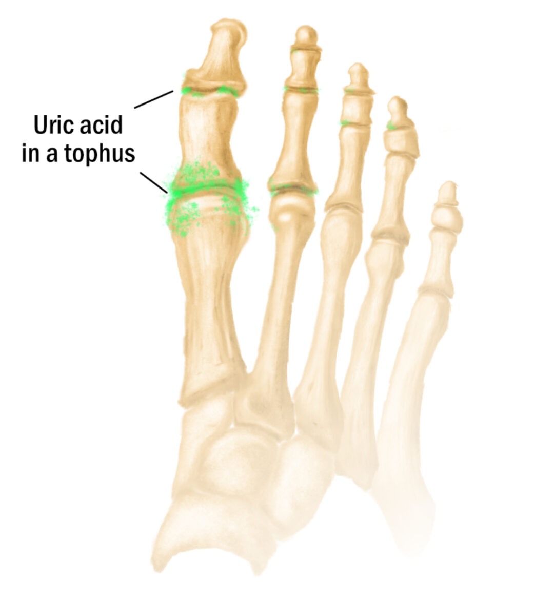 Can massage reduce gout pain? - Massage & Fitness Magazine